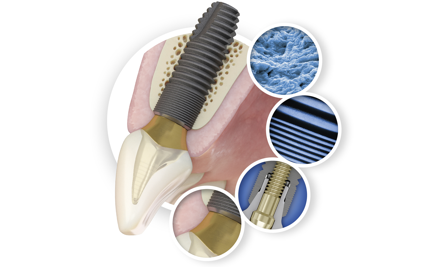 Dental Implant Systems | Dentsply Sirona UK